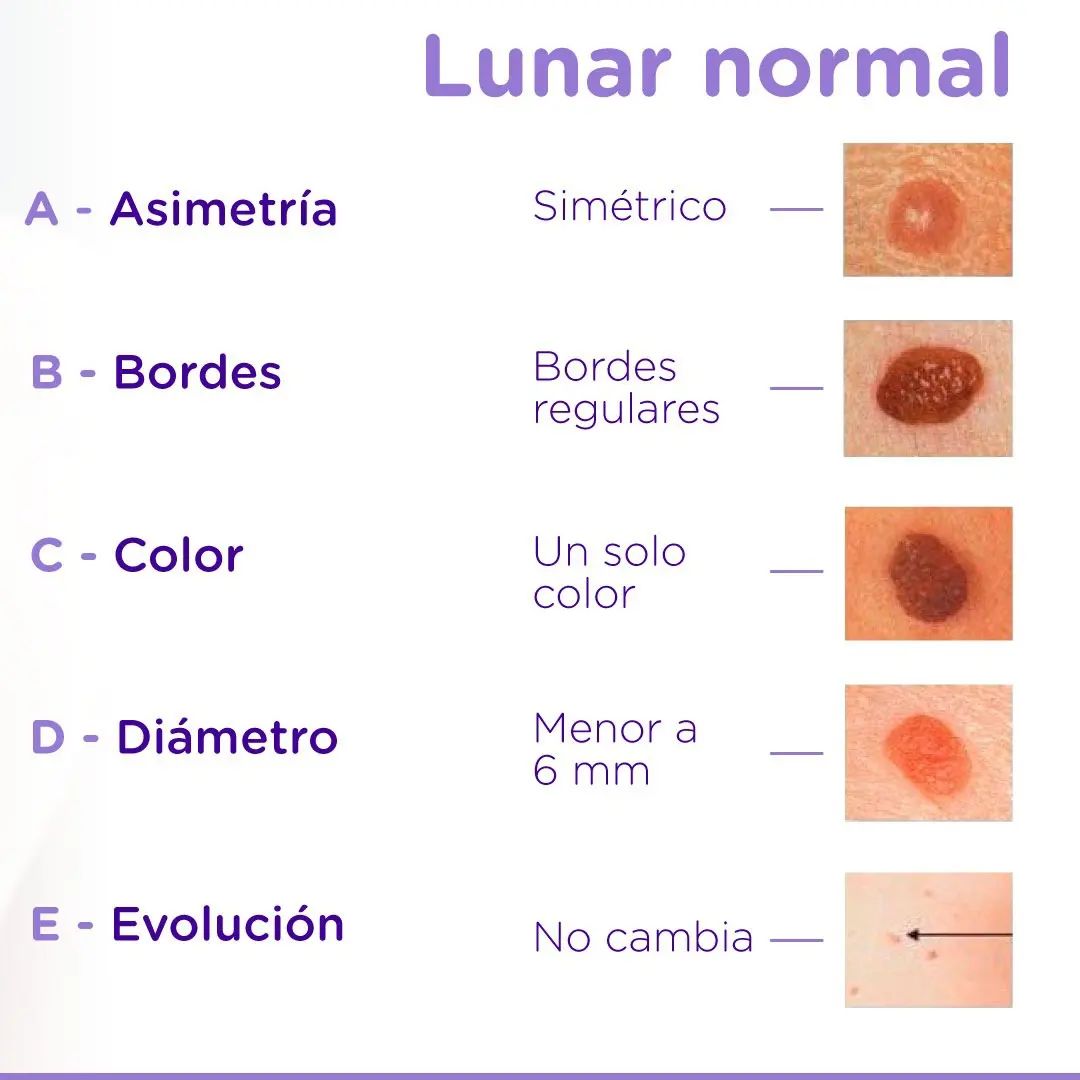 ¿Sabes cómo diferenciar un lunar normal de un melanoma? – Imágenes de ...