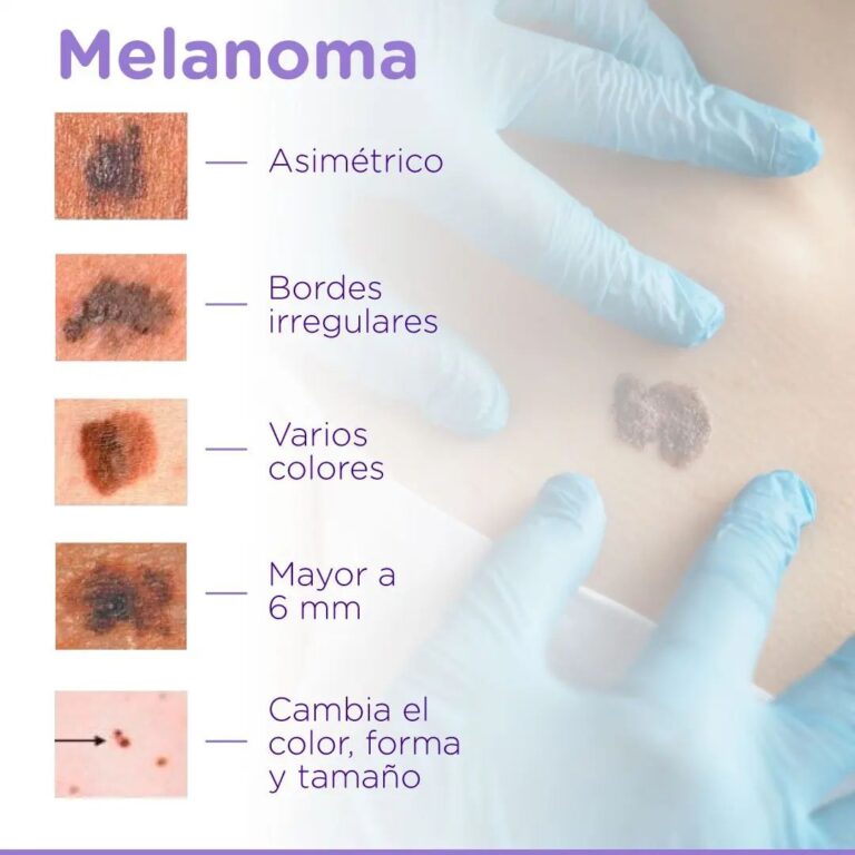 ¿Sabes cómo diferenciar un lunar normal de un melanoma? - Imágenes de ...